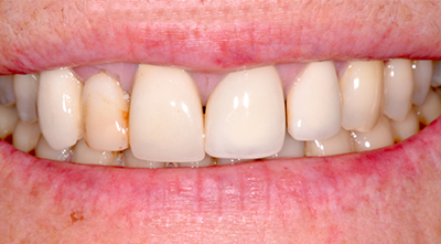 Smile Gallery - Jamaica Plain Dental