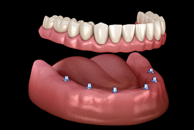 Dentures In Jamaica Plain, MA - Jamaica Plain Dental