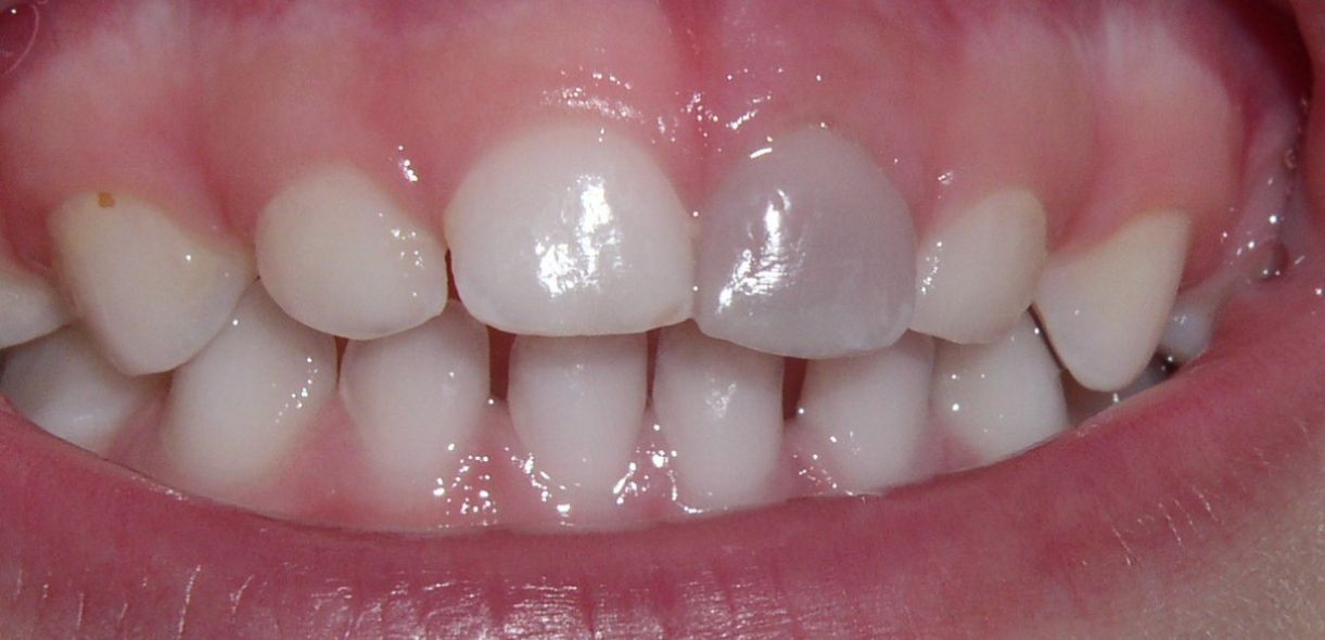 Black Tooth Emergency: Knowing Causes, Risks, And Urgency