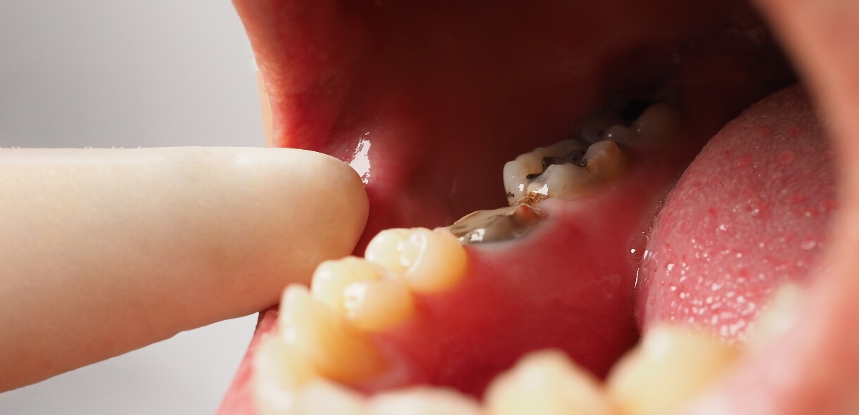Taking Care of a Cavity in Your Wisdom Tooth