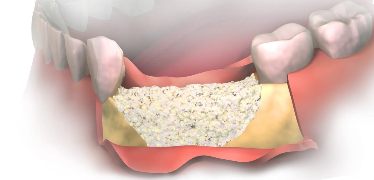 Understanding Bone Graft Healing: A Comprehensive Guide