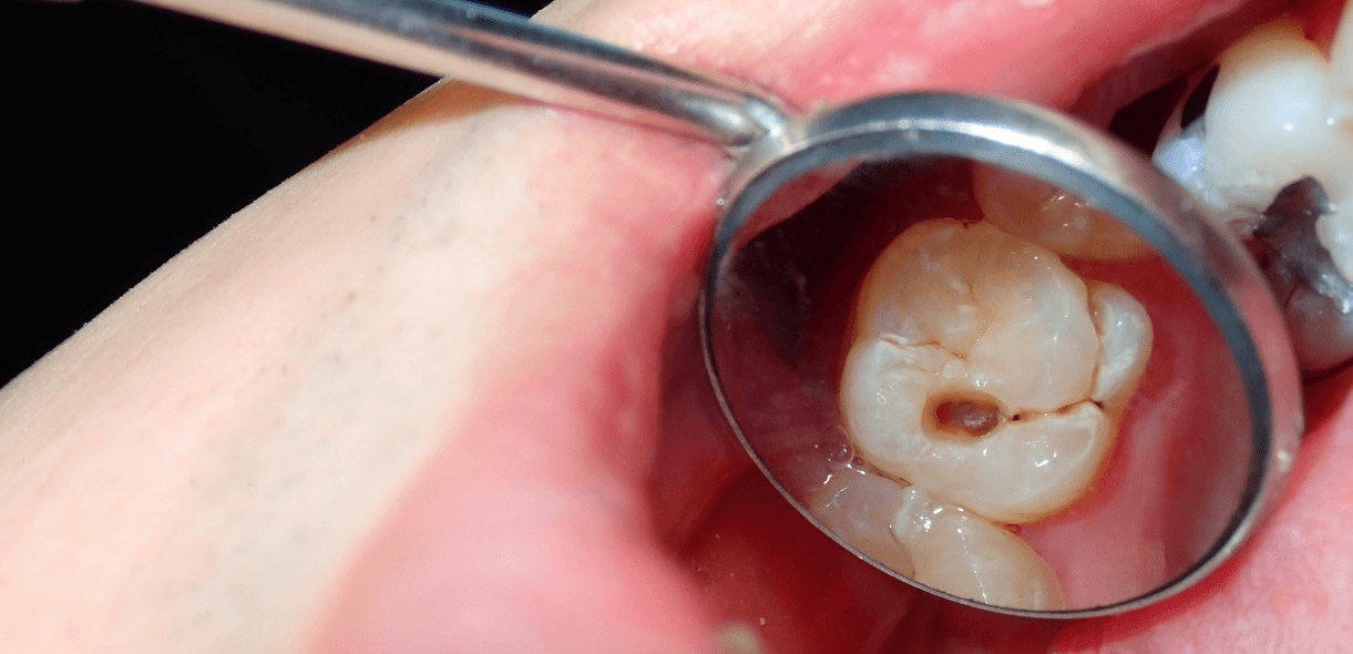 7 Home Remedies for Toothache: Effective Ways to Relieve Pain