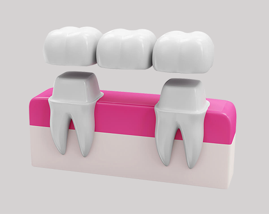 Implant Bridges Jamaica Plain MA - JP Dental