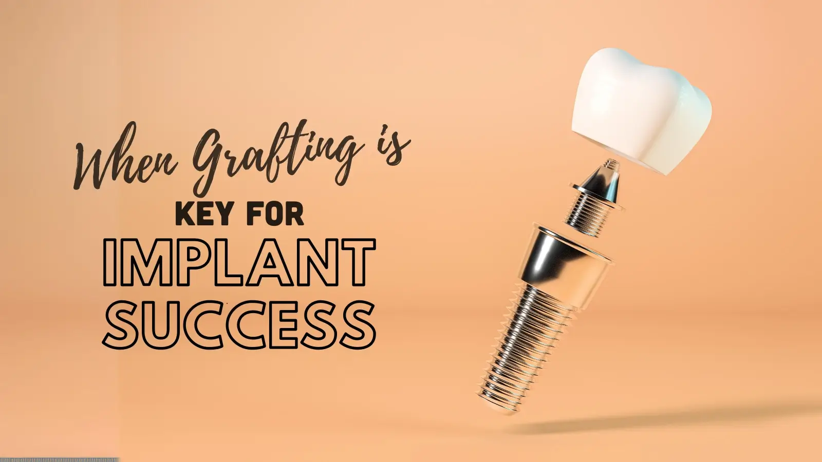 Boost Your Bone: When Grafting is Key for Implant Success - JP Dental