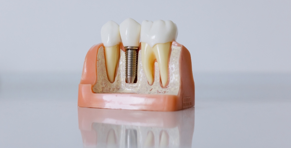 How Dental Implants Mimic Natural Teeth