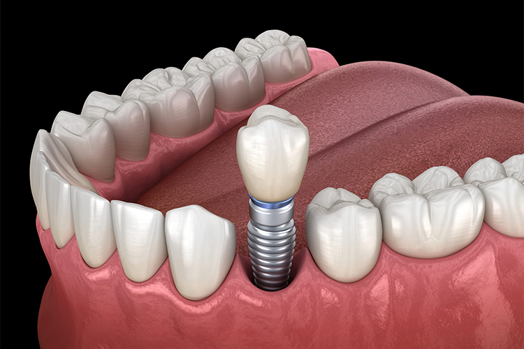 How Long Does a Dental Implant Treatment Take